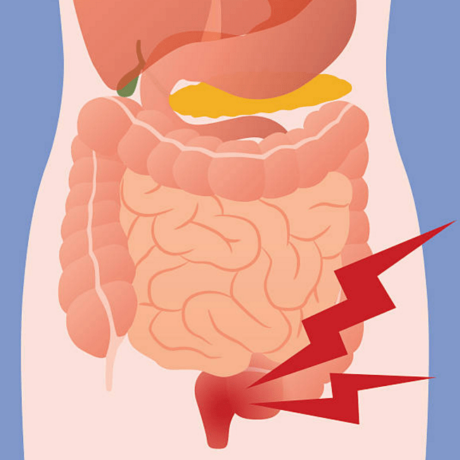 Rectal Bleeding Rectal Bleeding